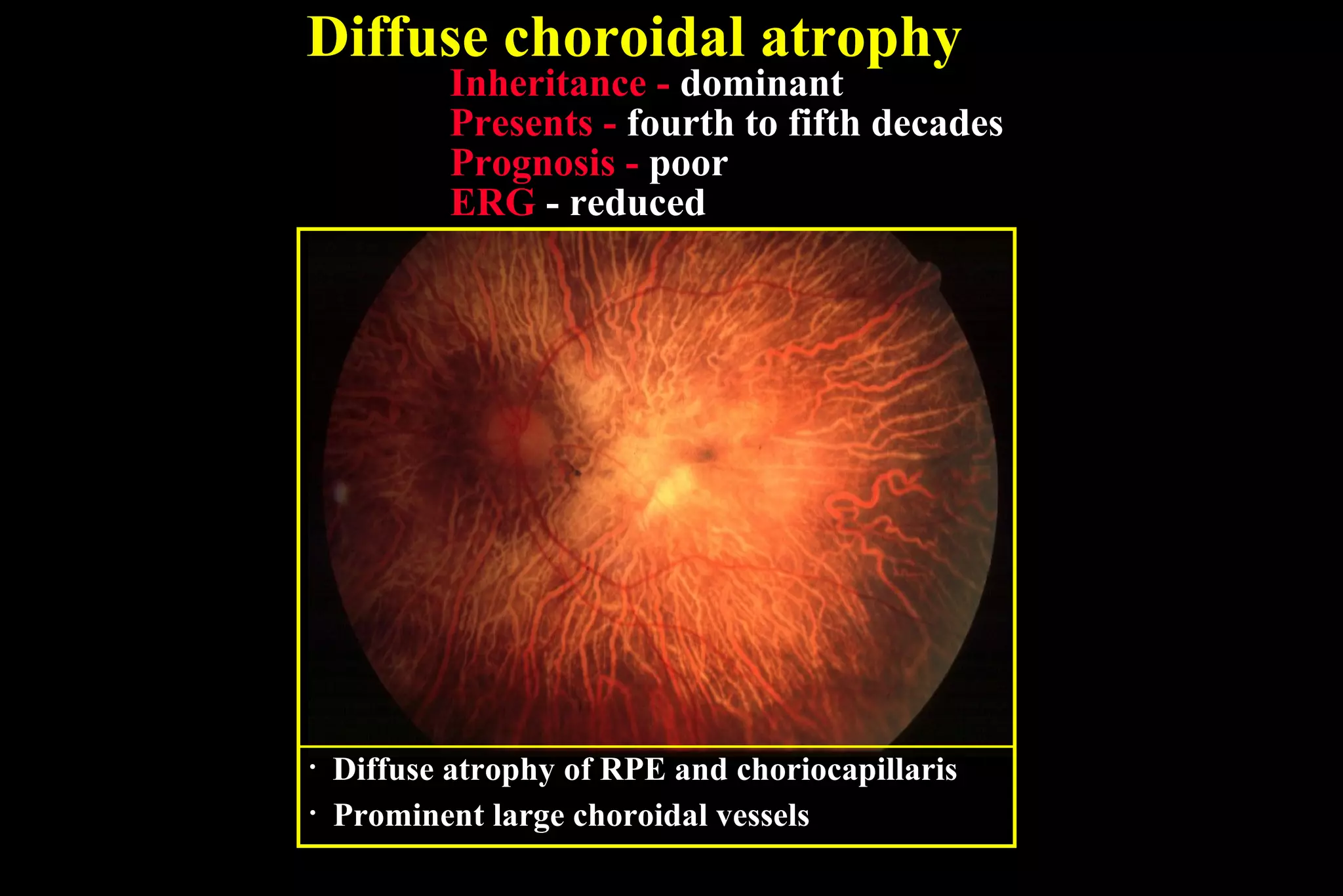 47 hereditary choroidal dystropathies | PPT