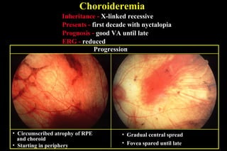 47 hereditary choroidal dystropathies | PPT