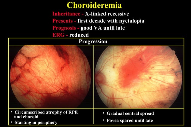 47 hereditary choroidal dystropathies | PPT | Eye and Vision Conditions ...
