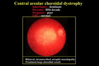 47 hereditary choroidal dystropathies | PPT