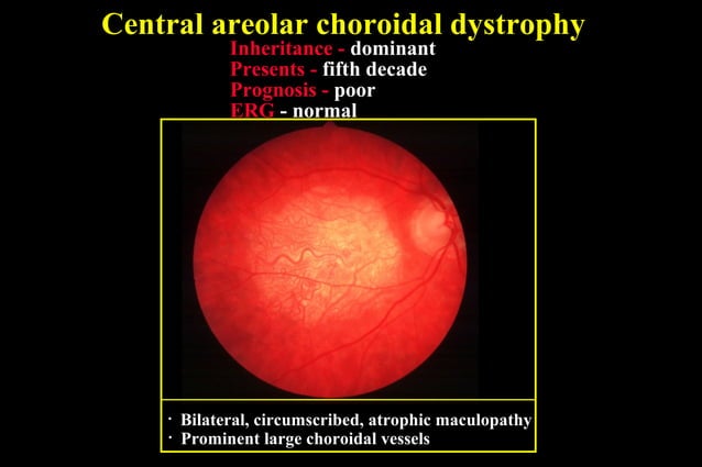 47 hereditary choroidal dystropathies | PPT | Eye and Vision Conditions ...