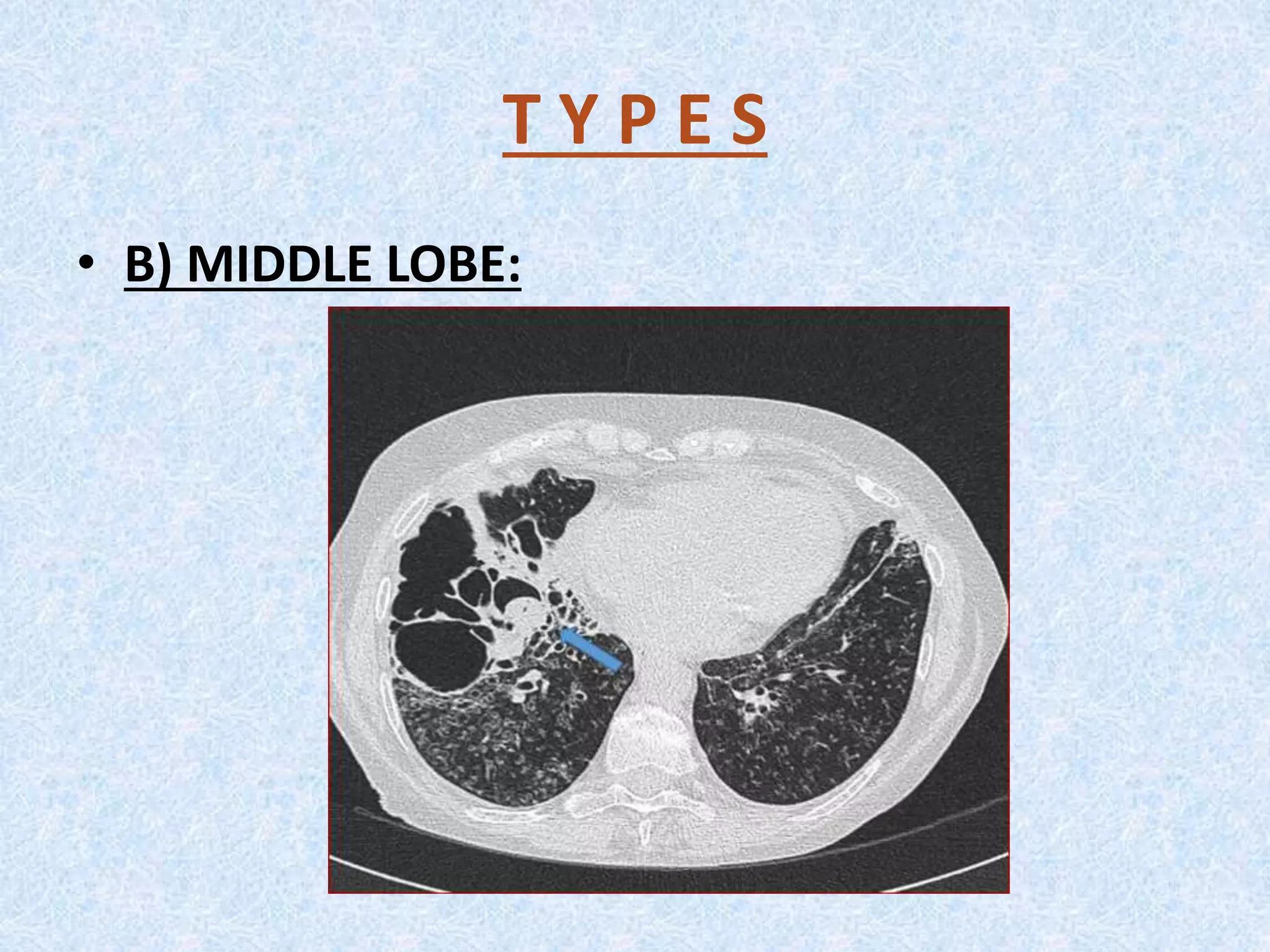 lung bronchiectasis pulmonology ( respiratory medicine ) | PPTX