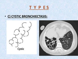lung bronchiectasis pulmonology ( respiratory medicine ) | PPTX