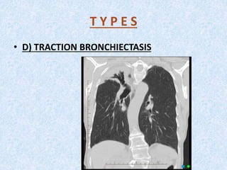 lung bronchiectasis pulmonology ( respiratory medicine ) | PPTX