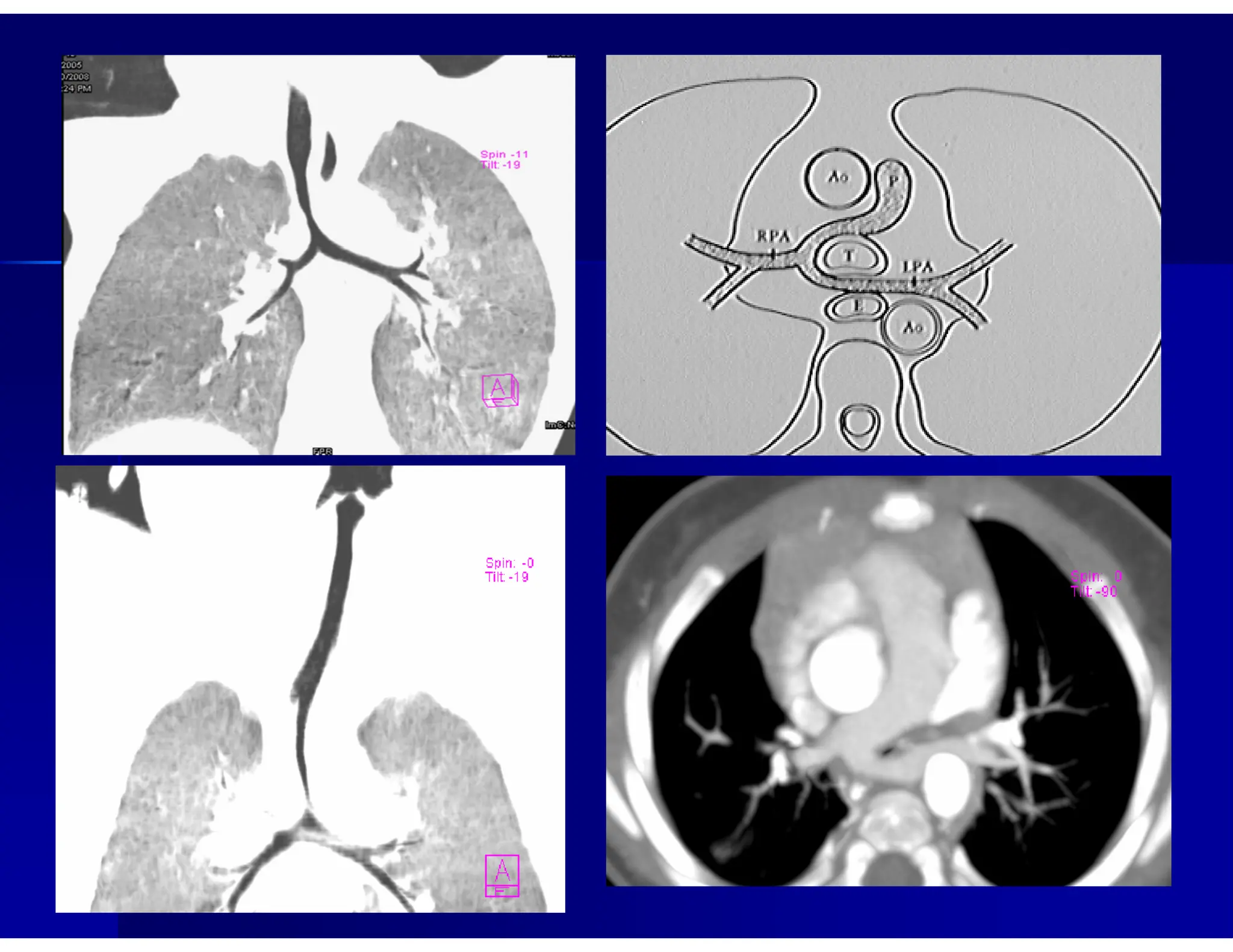 Radiology in Congenital Pulmonary Diseases - HCM UMP | PDF