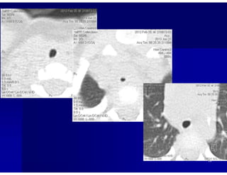 Radiology in Congenital Pulmonary Diseases - HCM UMP | PDF