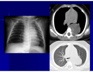 Radiology in Congenital Pulmonary Diseases - HCM UMP | PDF