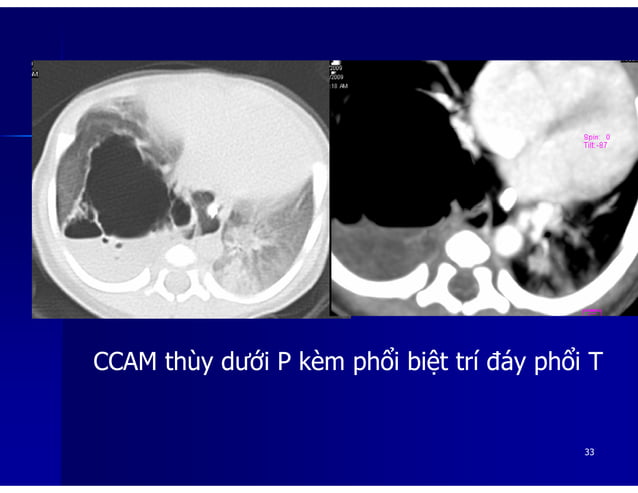 Radiology in Congenital Pulmonary Diseases - HCM UMP | PPT