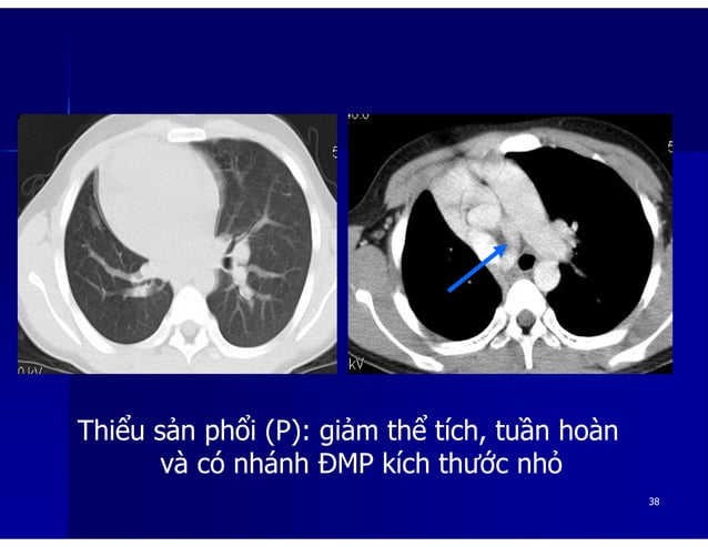 Radiology in Congenital Pulmonary Diseases - HCM UMP | PPT