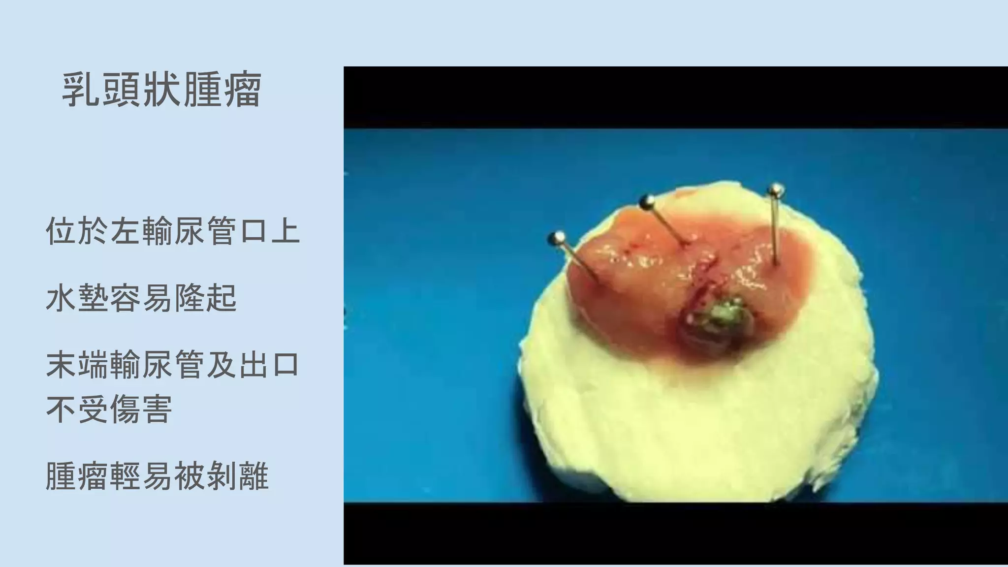BTESD Bladder Tumor Endoscopic Submucosal Dissection development in ...