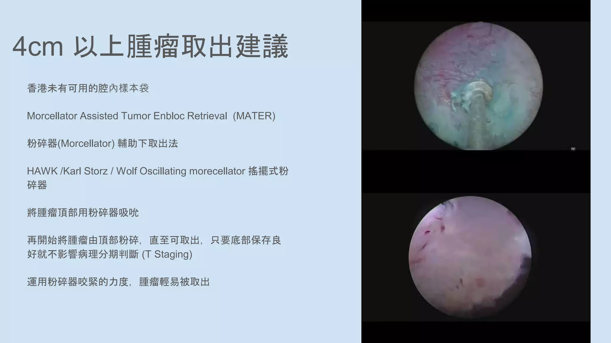 BTESD Bladder Tumor Endoscopic Submucosal Dissection development in ...