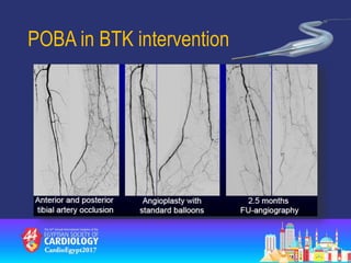 Below the knee intervention; balloons or stents | PPT