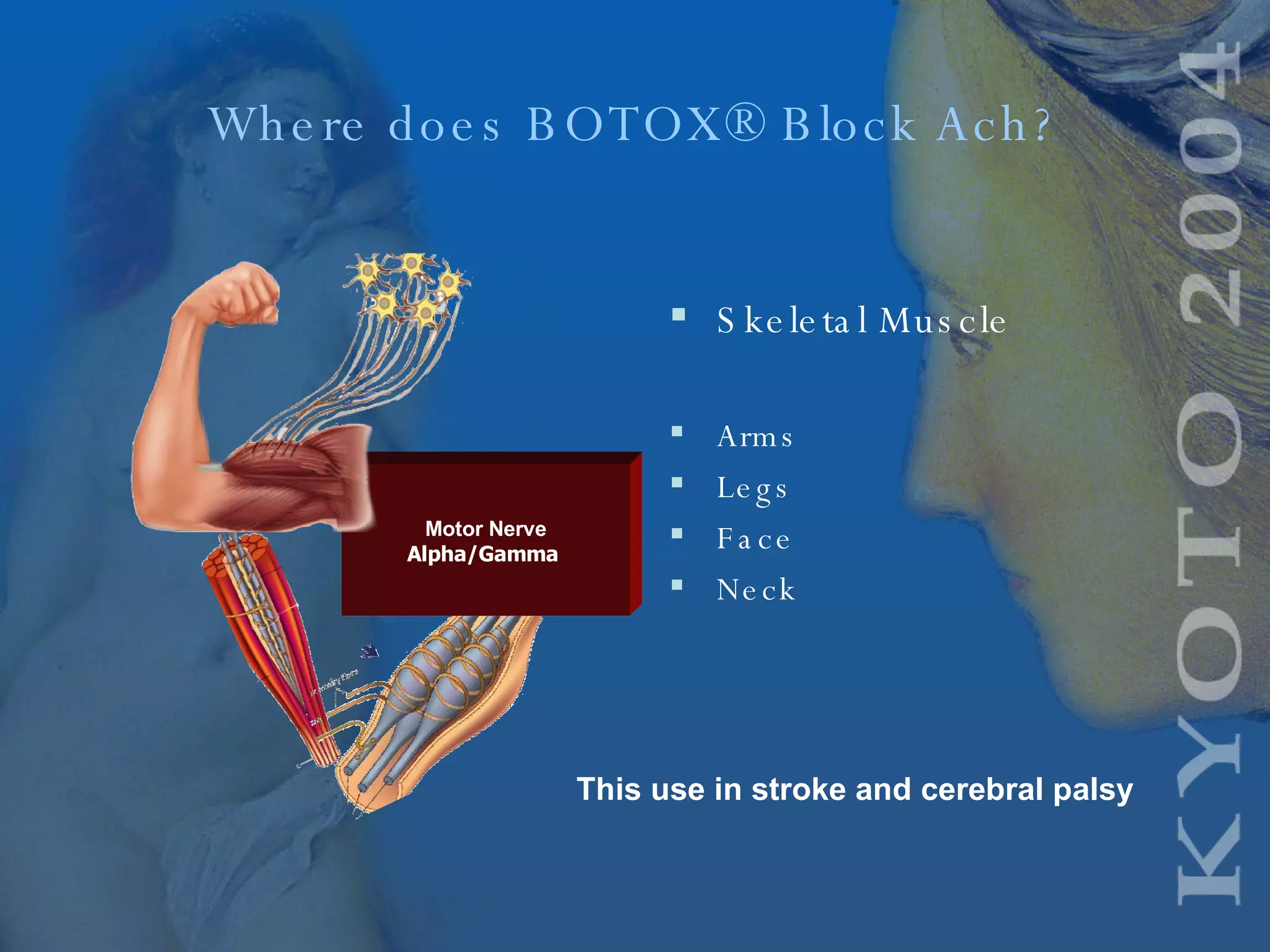 The Action of Botox on Migraine | PPT