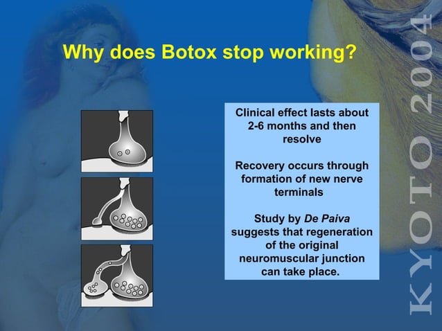 The Action of Botox on Migraine | PPT | Brain and Nervous System ...