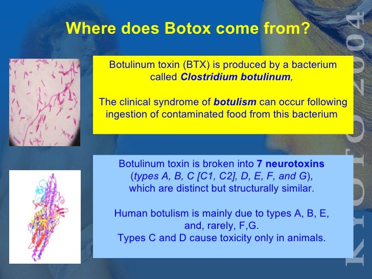 The Action of Botox on Migraine