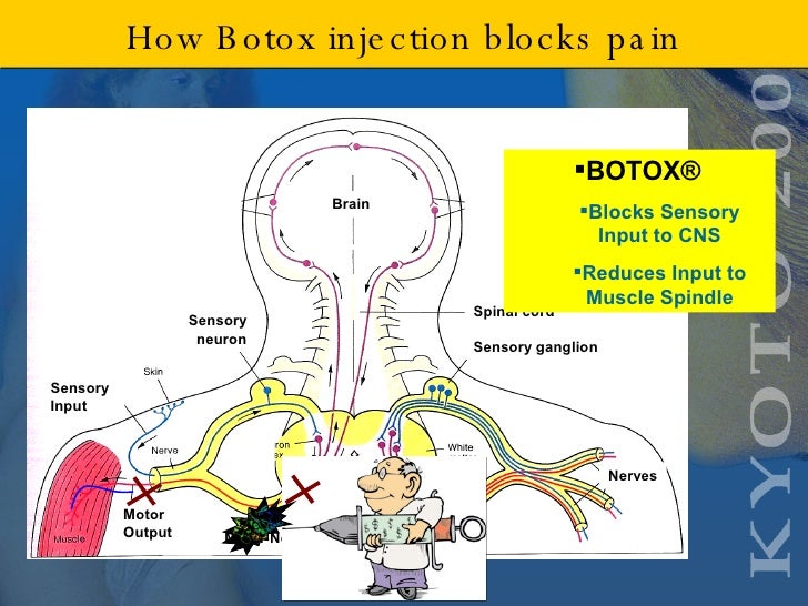 The Action of Botox on Migraine