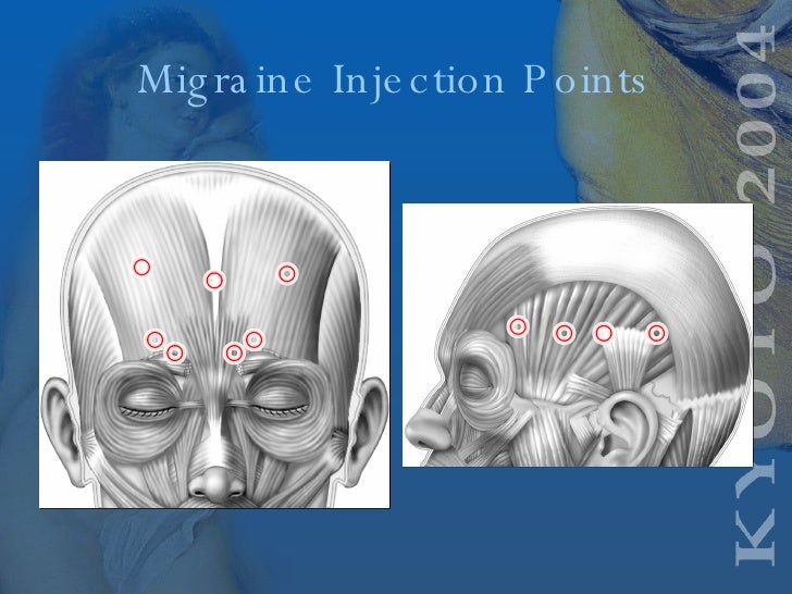 The Action of Botox on Migraine