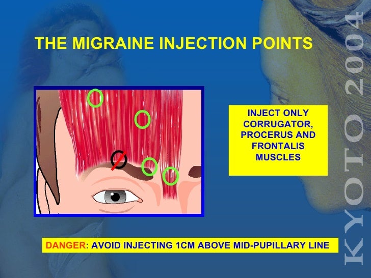 The Action of Botox on Migraine