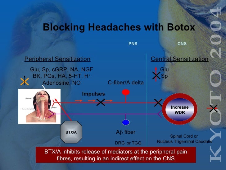 The Action of Botox on Migraine
