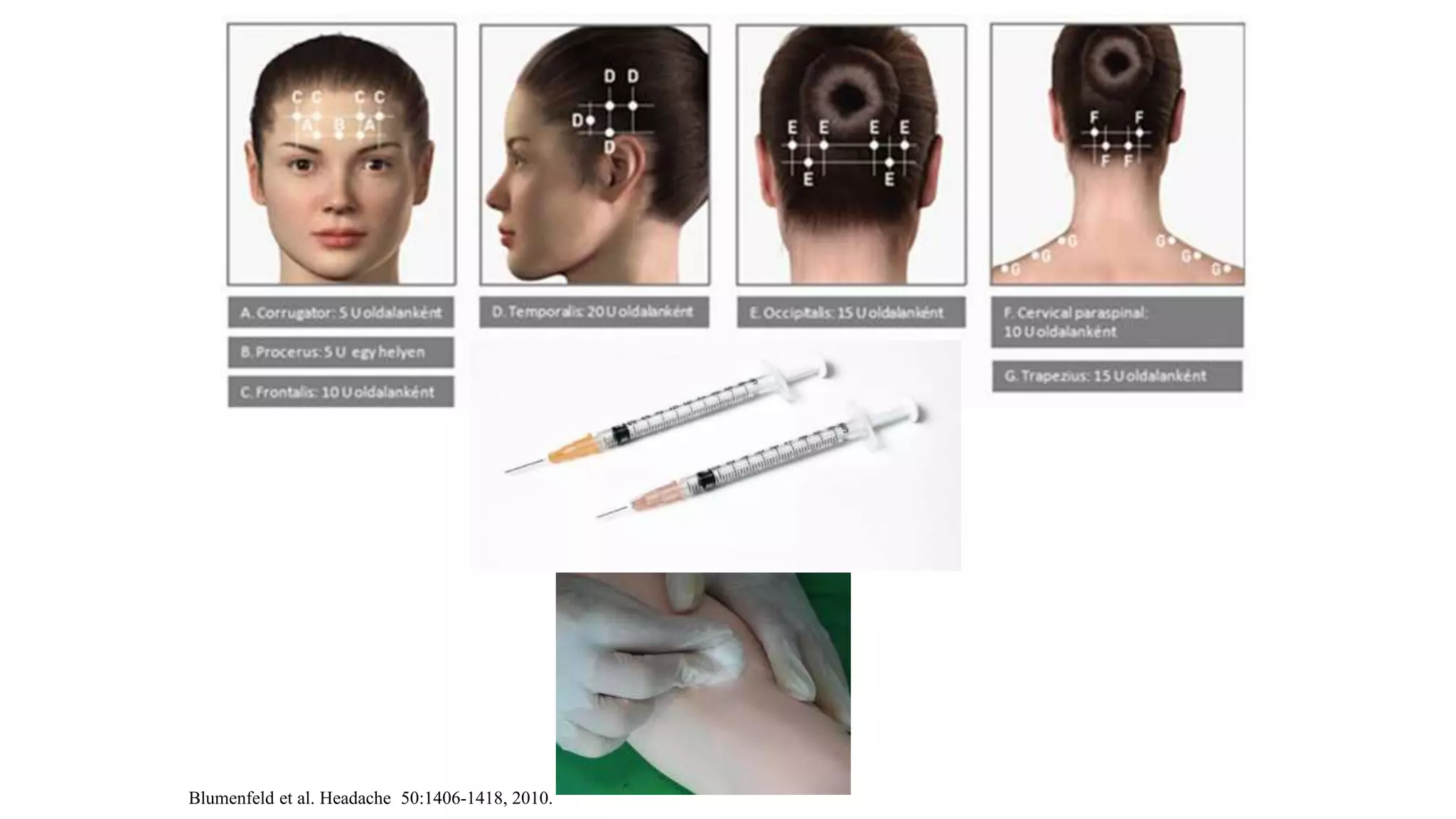 Medical use of botulinum toxin - Botulinum toxin orvosi felhasználása | PPT