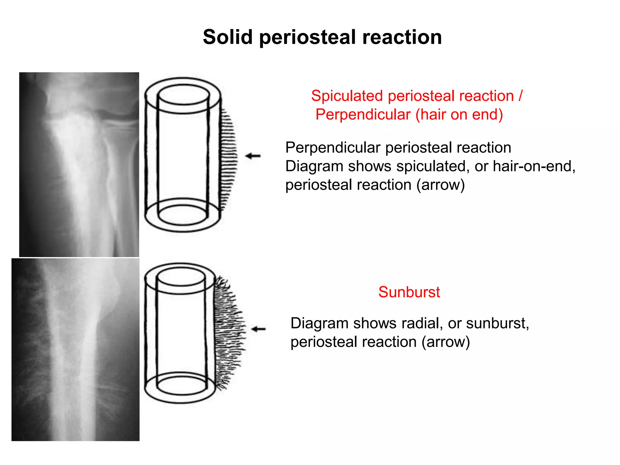 radiographic analysis of bone tumors | PPTX