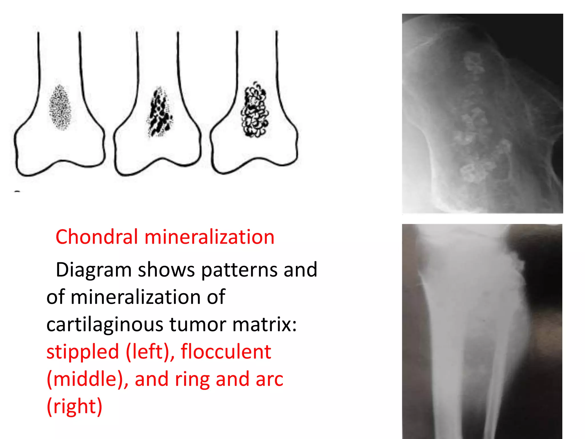 radiographic analysis of bone tumors | PPTX