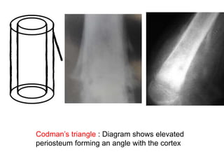 radiographic analysis of bone tumors | PPTX