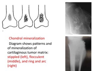 radiographic analysis of bone tumors | PPT