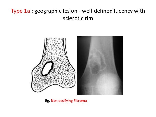 radiographic analysis of bone tumors