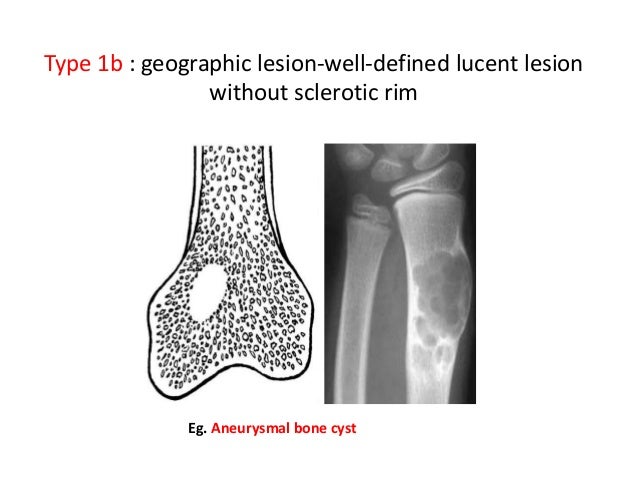 radiographic analysis of bone tumors