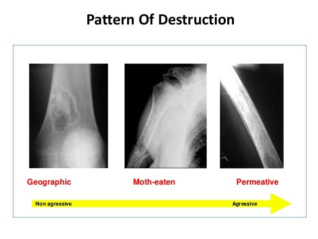 radiographic analysis of bone tumors
