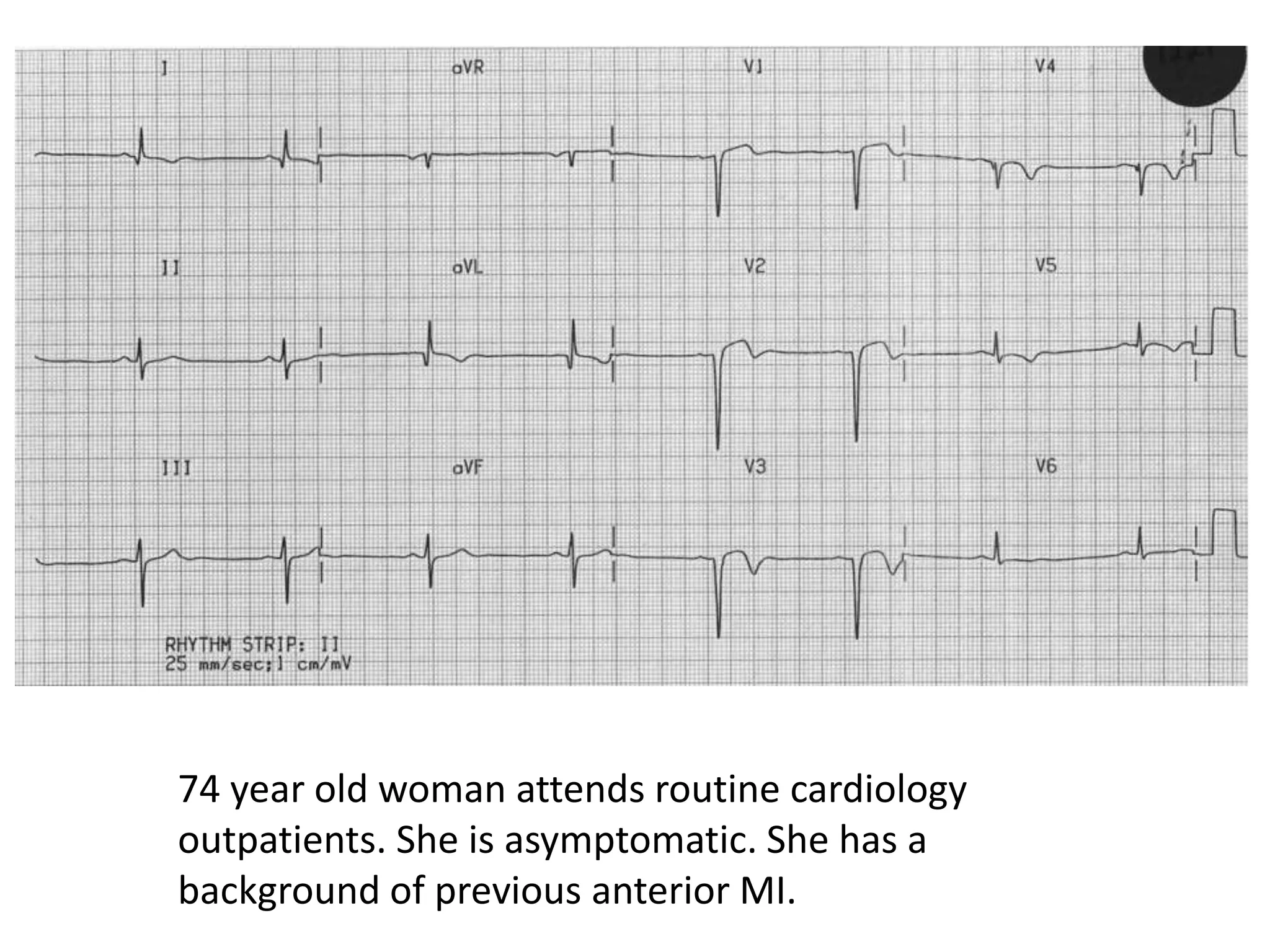 A Structured Method for ECG Interpretation | PPT
