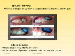 Buccal and sublingual drug delivery system | PPTX