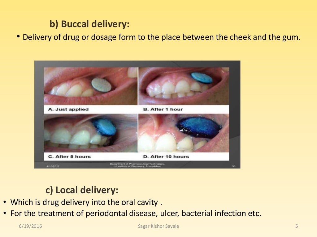 Buccal and sublingual drug delivery system Buccal and sublingual drug delivery system