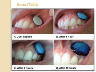 Buccal Administration