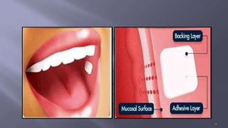 Buccal drug delivery system | PPTX