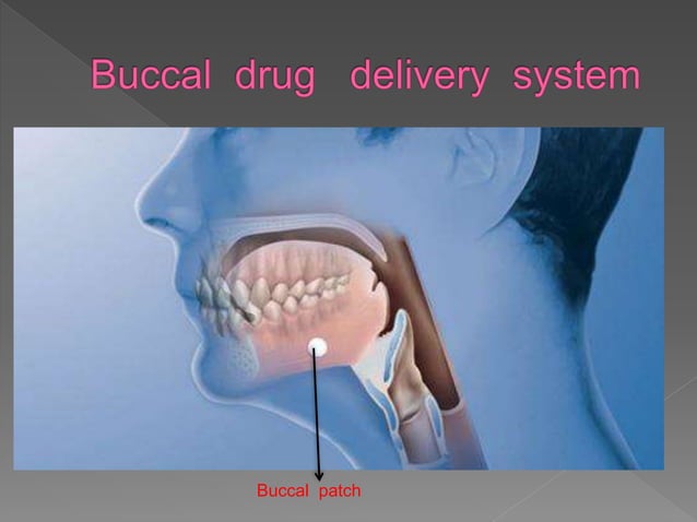 Buccal drug delivery system | PPTX | Ear, Nose and Throat Conditions ...