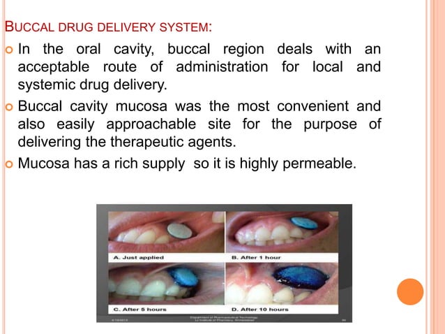 Buccal drug delivery system | PPTX