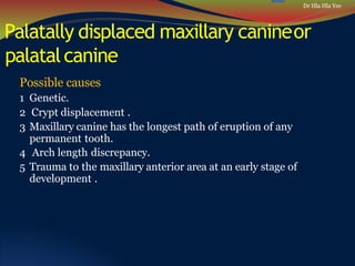 buccallyeruptedmaxillarycanine-180803165227-converted (2).pptx