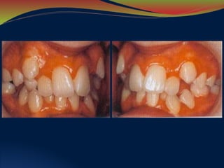 buccallyeruptedmaxillarycanine-180803165227-converted (2).pptx