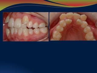 buccallyeruptedmaxillarycanine-180803165227-converted (2).pptx