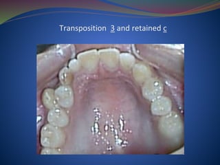 Buccally erupted maxillary canine | PPTX
