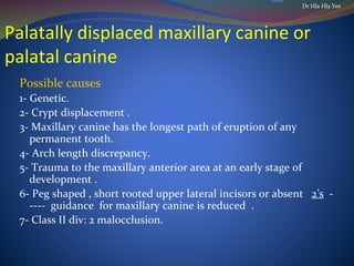 Buccally erupted maxillary canine | PPTX