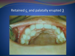 Buccally erupted maxillary canine | PPTX