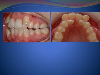 Buccally erupted maxillary canine | PPTX