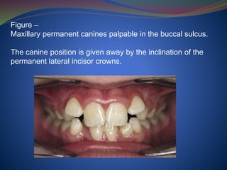 Buccally erupted maxillary canine | PPTX