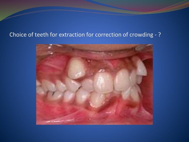 Buccally erupted maxillary canine