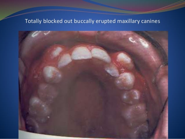 Buccally erupted maxillary canine