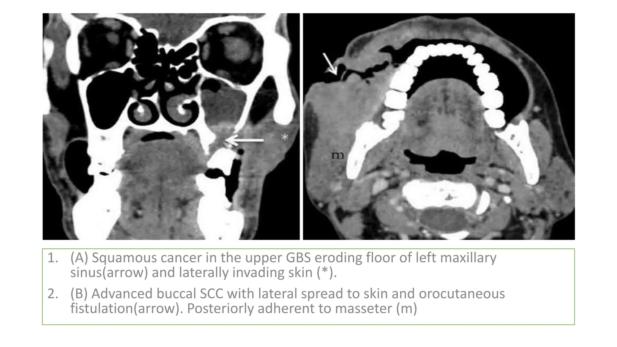 Normal Anatomy of Buccal mucosa and cancer | PPTX