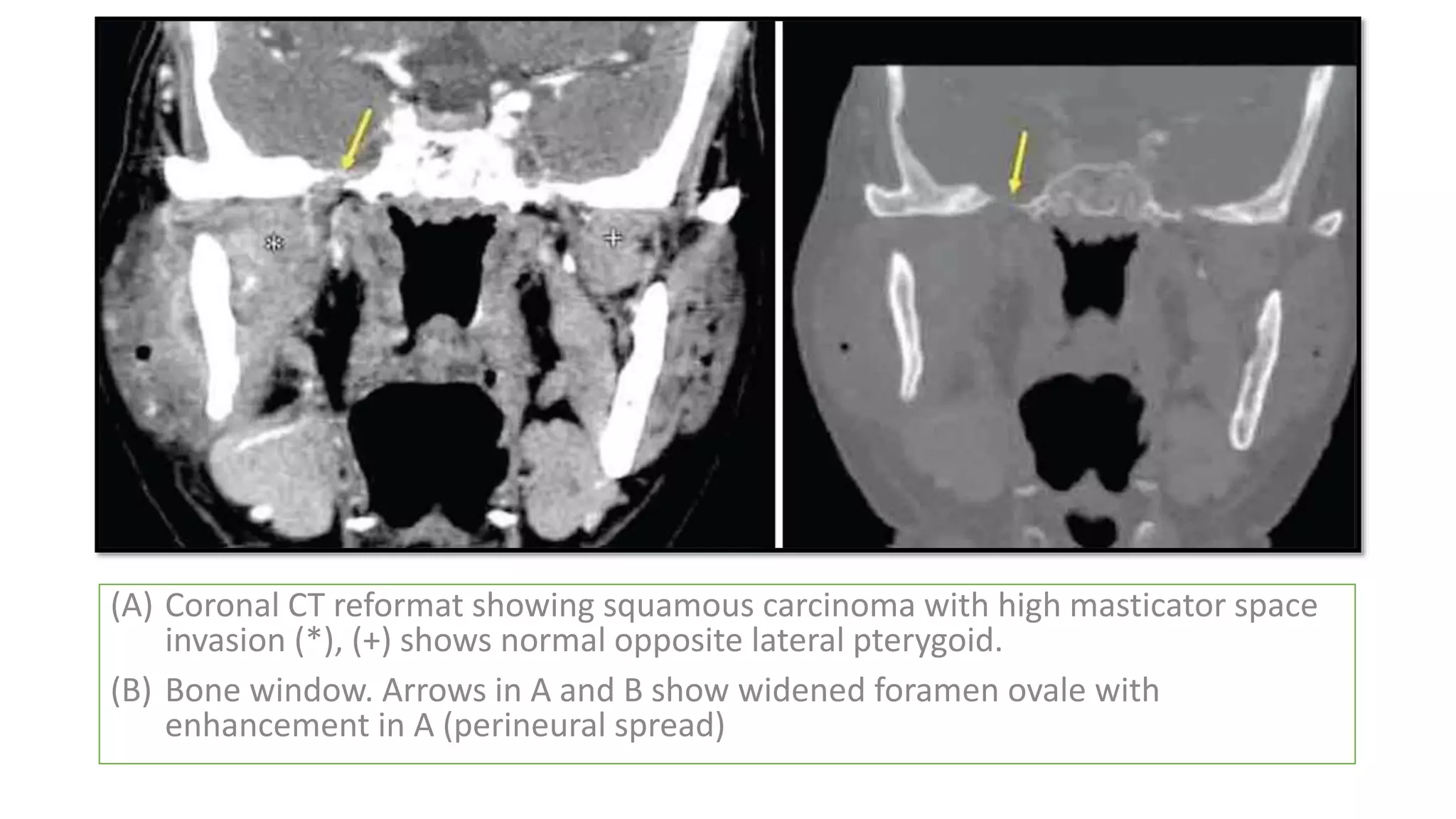 Normal Anatomy of Buccal mucosa and cancer | PPTX